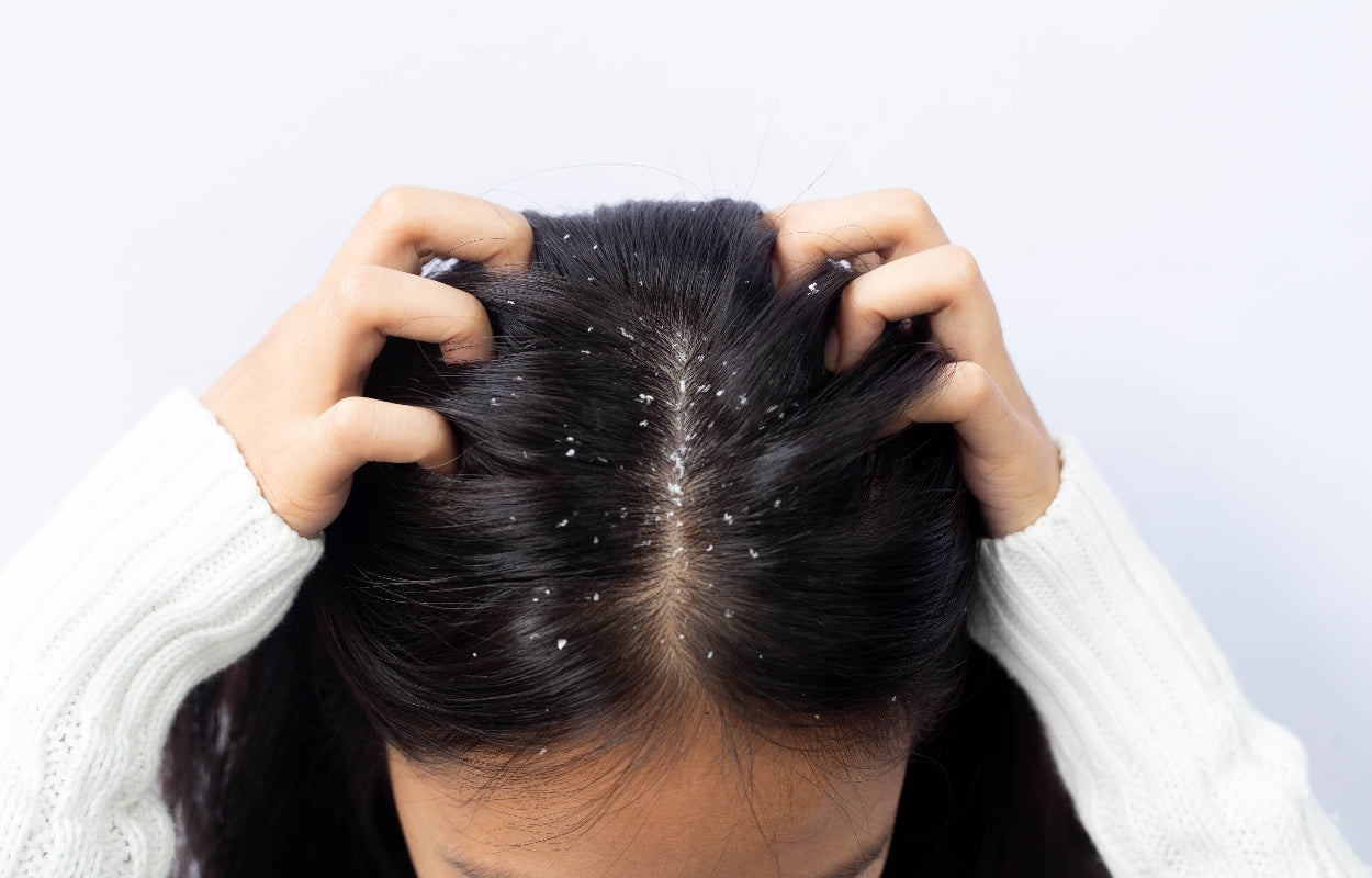 The Connection Between Dandruff and Hair Loss – myUpchar Ayurveda